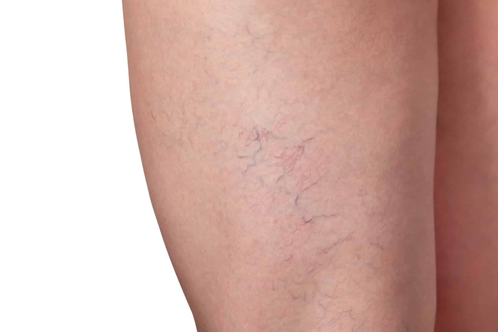 Facial & Leg Veins - Laser Aesthetic Spa